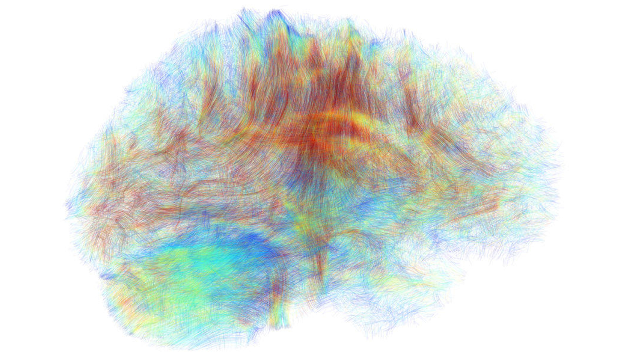 A model for brain activity during brain stimulation therapy | Penn Today